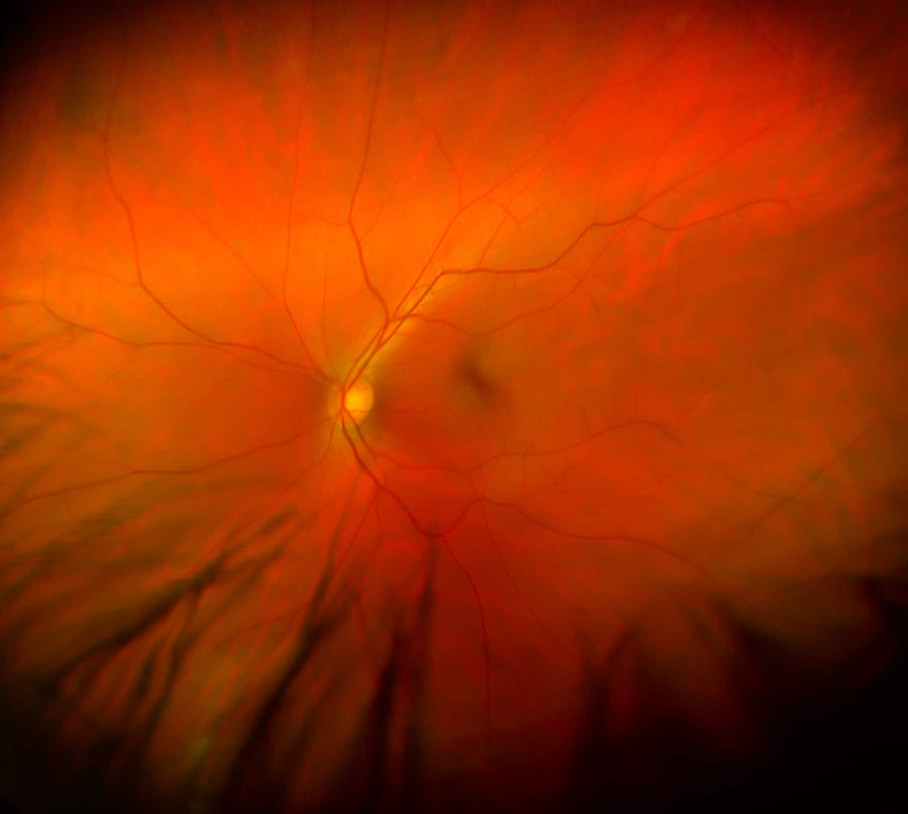 What Is a Diabetic Eye Exam? | Advanced Sight Center